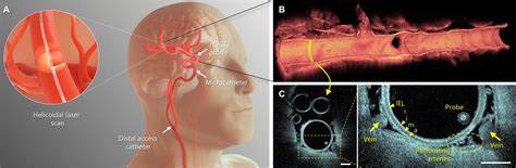 Volumetric Microscopy Of Cerebral Arteries With A Miniaturized Optical