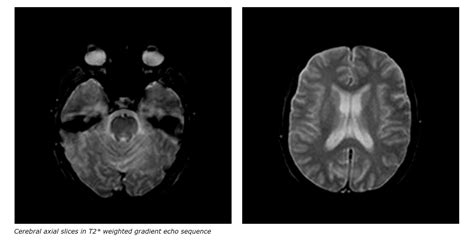 Mri Sequences Spoiled Gradient Echo Sequences E Mri