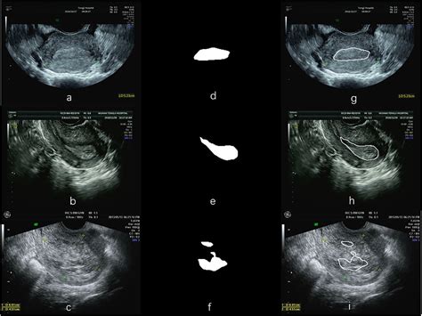 Endometrium Ultrasound