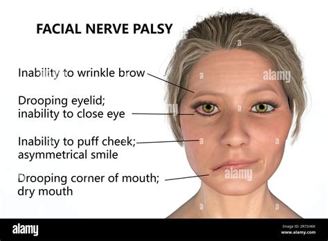 Facial Paralysis