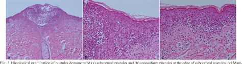 Figure 1 From Acute Generalized Exanthematous Pustulosis Agep And