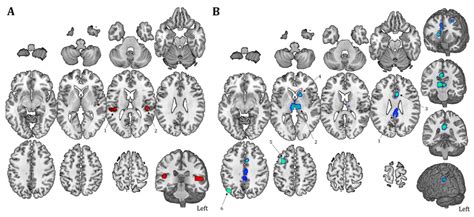 Task And Resting State Related Activation Map A Temporal Lobes Are