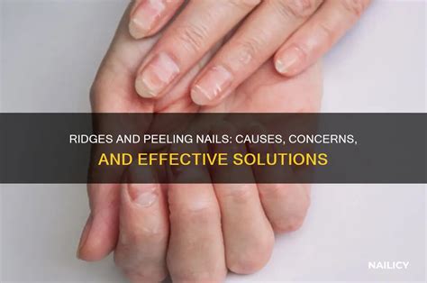 Ridges And Peeling Nails Causes Concerns And Effective Solutions