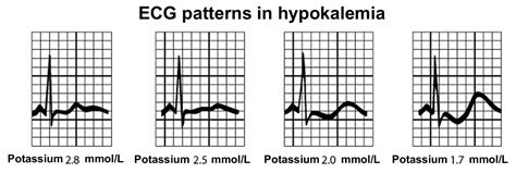 Hypokalemia Definition Causes Signs Symptoms Diagnosis And Treatment