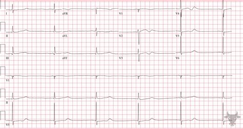 Tachy Brady Syndrome In Ecg At Douglas Jacobson Blog