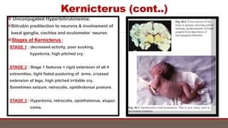 Neonatal Jaundice Final Pptx