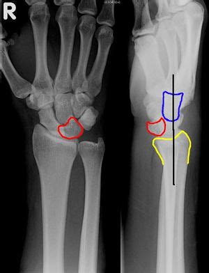 Hill Sachs Lesion Causes Symptoms Treatment Samarpan