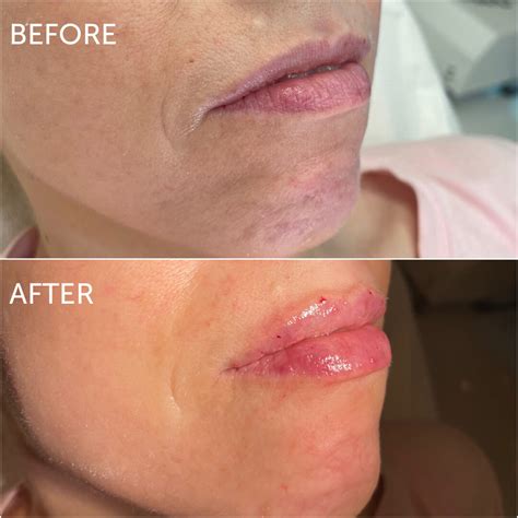 How To Reduce Bruising And Swelling After Lip Fillers Infoupdate Org