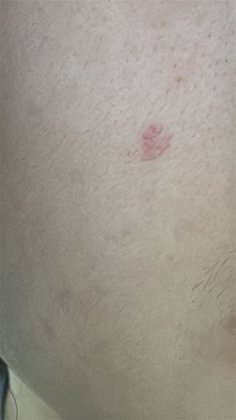 피부 얼굴에 빨간 흉 생김 지식in