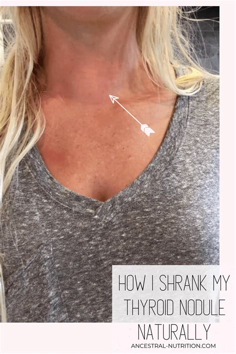 How I Shrank My Thyroid Nodules Naturally Ancestral Nutrition