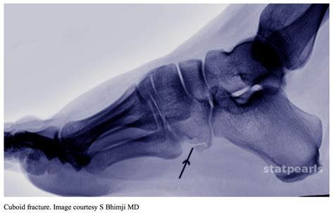 624 Cuboid Stress Fracture Fundamentals For Runners Doc