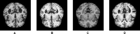 A Fine Tuned Convolutional Neural Network Model For Accurate Alzheimers… Matlab For Neuroscience