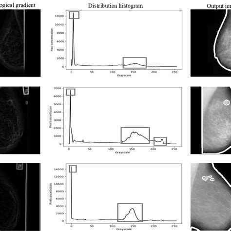 Processing Of Mammography Images By Morphological Gradient And Pixel Download Scientific