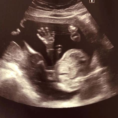 La Historia De La Beba Que Naci En El Lugar Menos Pensado De Repente Mir Y Vi La Cabeza