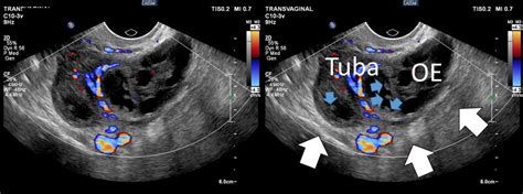 Ultrassonografia Com Teratoma Ovariano