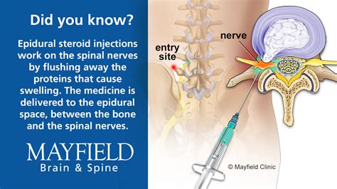 Mayfield Brain And Spine