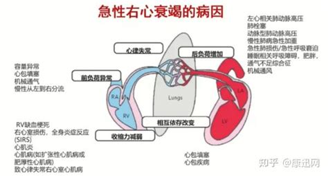 临床医学急性右心衰竭的判别和急诊处理 知乎