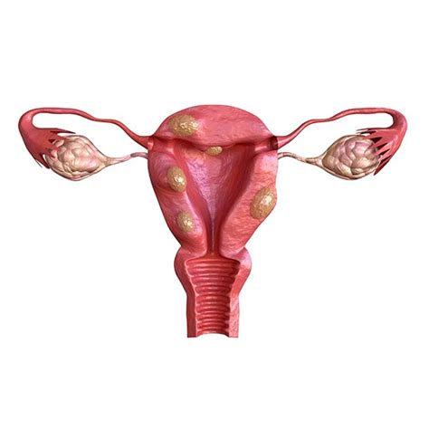 Embolization To Treat Uterine Fibroids With Bleeding And Severe Anemia
