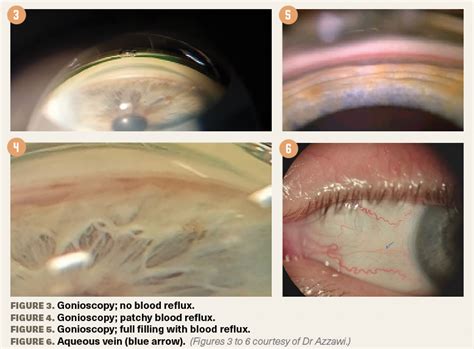 Understanding Schlemm Canal To Improve The Results Of Stent Surgery