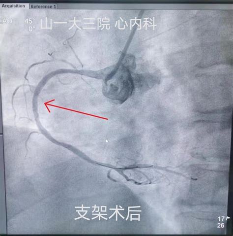 冠脉cta Vs 冠脉造影 春雨医生
