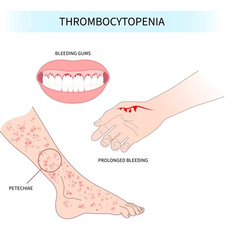 Immune Thrombocytopenia Itp Rcemlearning