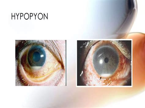 Uveitis Pptx