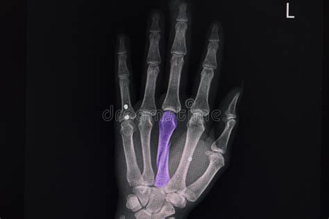 Fractured Third Metacarpal Bone Stock Image Image Of Joint Medicine