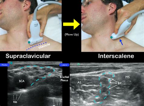 Supraclavicular Nerve Block