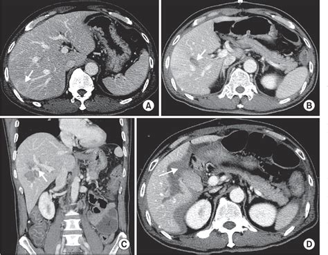 Figure 1 From Delayed Hepatic Rupture After Radiofrequency Ablation For Colorectal Hepatic