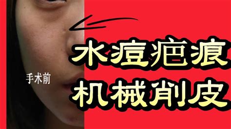 水痘疤痕的去除方法機械削皮 Youtube