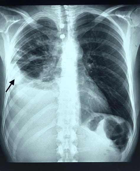 Chest X Ray Showing Right Unilateral Pleural Effusion Black Arrow Download Scientific Diagram