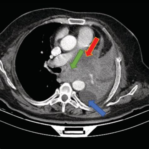 Lung Computed Tomography Scan Axial With Contrast Shows A Large