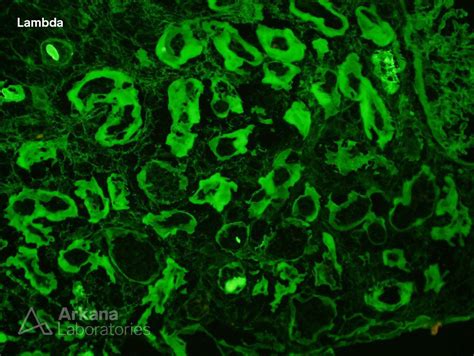 Light Chain Deposition Disease Teaching Points Arkana Laboratories