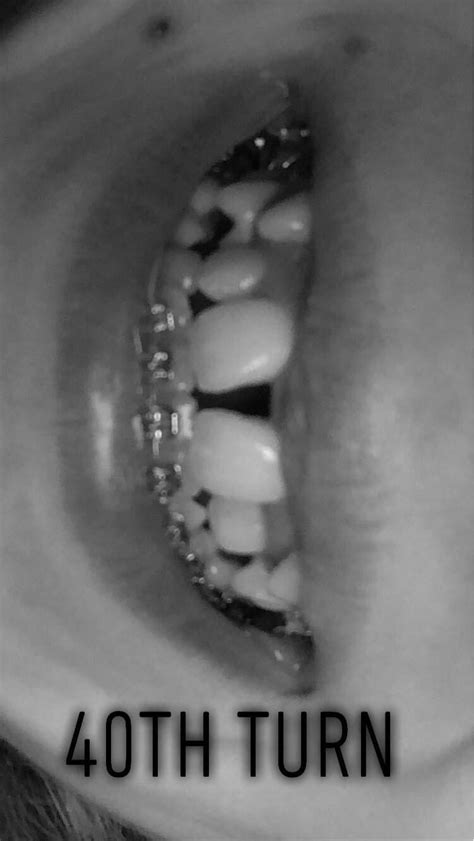 Related To My Last Post Before And After Sarpe Surgery Rjawsurgery