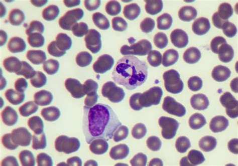 Low Relative Lymphocyte Count Associated With Higher Mortality In Copd Pulmonology Advisor