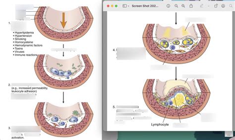 Diagram Of Atherosclerosis 2 Morphology And Steps Quizlet