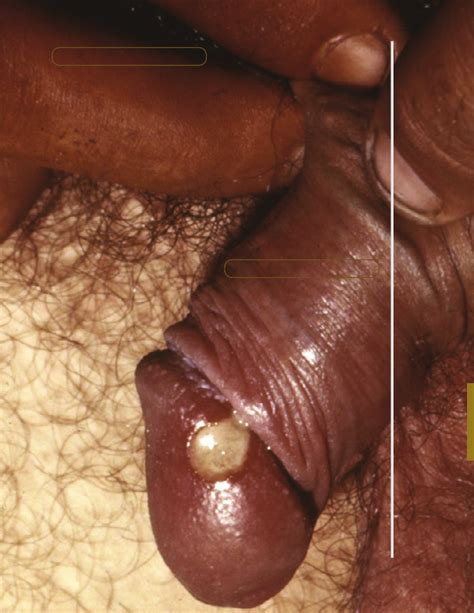 Coccobacilli Facultative Anaerobes Notes Diagrams Download PDF Osmosis