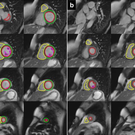 Lv And Rv Contouring In End Diastole Panel A And End Systole Panel