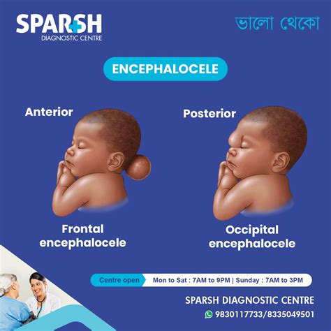Encephalocele Causes Symptoms Diagnosis And Treatment Sparsh