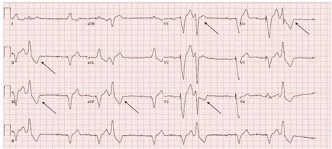 Preoperative 12 Lead Ekg Lbbb In V1 Rs Transition In V3 4 And A