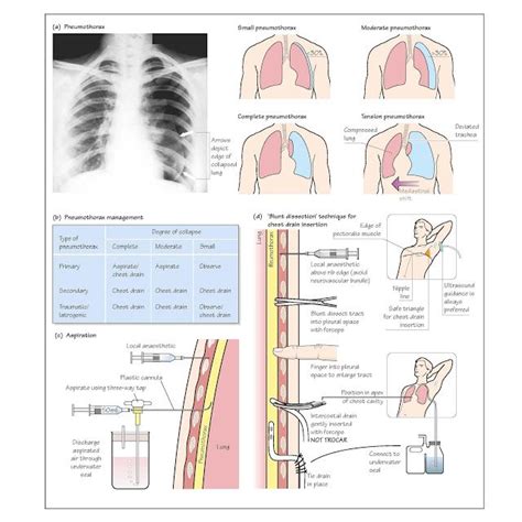 Left Apical Pneumothorax Jensentemay