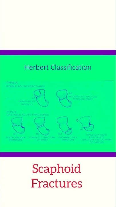 Herbert Classification For Scaphoid Orthopaedicprinciples Shorts