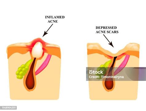피부에 염증이 여드름 염증이 있는 여드름 피부의 구조 여드름 흉터 건강관리와 의술에 대한 스톡 벡터 아트 및 기타 이미지 건강관리와 의술 다이어그램 미세구멍 Istock