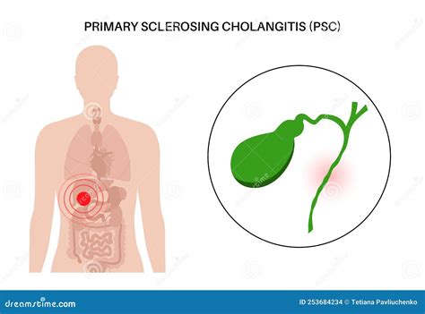 Primary Sclerosing Cholangitis Cartoon Vector