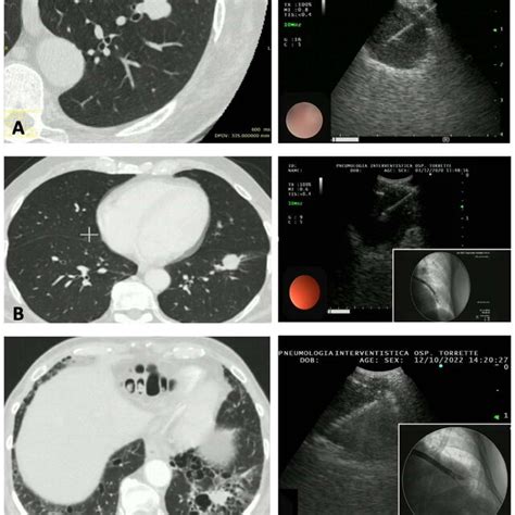 Three Cases Of Peripheral Pulmonary Nodules Of The Left Lung Approached