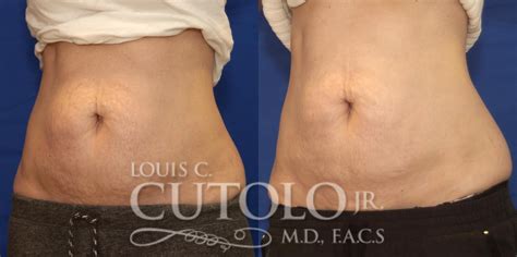 Bodytite Before And After Pictures Case 186 Brooklyn Staten Island