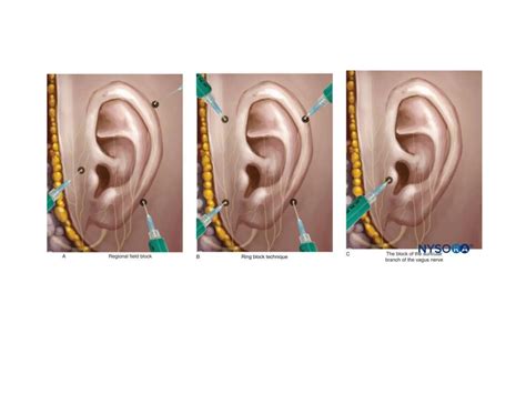 Scalp Block Scalp Block Scalp Block Scalp Pptx