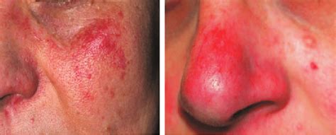 Erythematotelangiectatic Rosacea Note Presence Of Inflammation On Skin