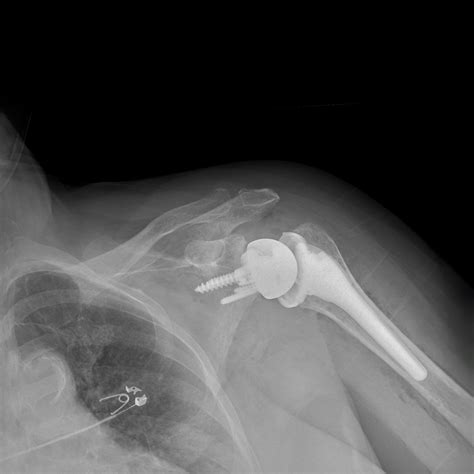 Dr Mcclintocks Shoulder X Ray Image Gallery Kyle Mcclintock Do Orthopedic Surgeon