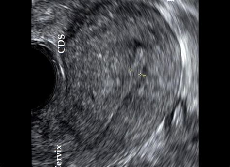Uterine Fibroid Instance Segmentation Dataset And Pre Trained Model By Manoj